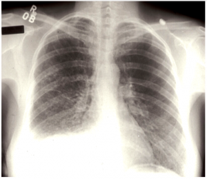 Kondisi Paru Yang Tidak Biasa - Philip Eng Respiratory & Medical Clinic