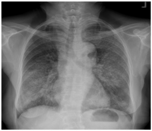 Kondisi Paru Yang Tidak Biasa - Philip Eng Respiratory & Medical Clinic